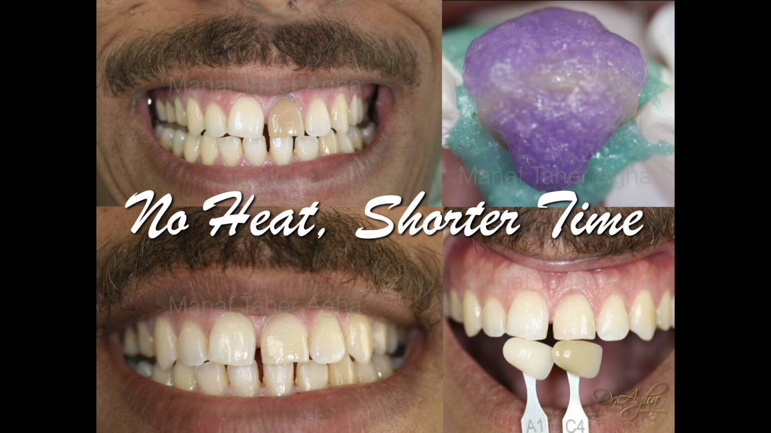 Laser Tooth Bleaching – Dr Manaf Agha