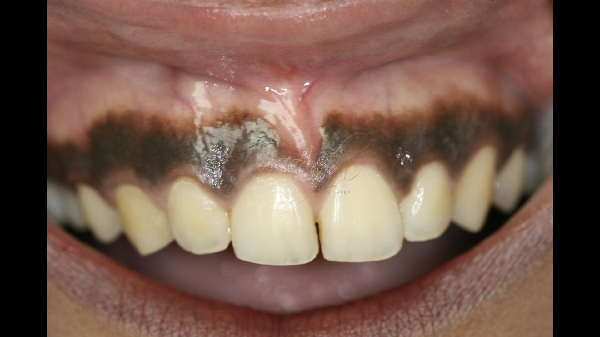 Laser Gingival Depigmentation in Dubai | Pink Gums Treatment